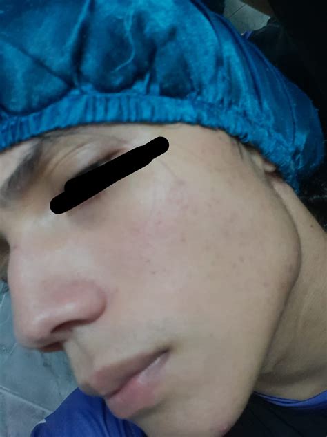 Facial Asymmetry And Braces Rorthotropics