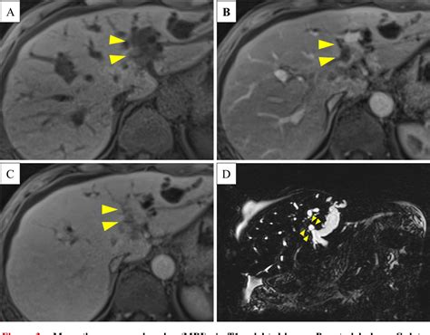 Figure 1 From Disseminated Carcinomatosis Of Bone Marrow As The Initial