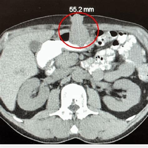 Soft Tissue Computed Tomography Found A Large Partially Necrotic