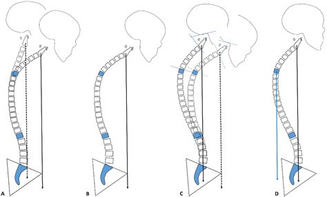 Spinopelvic Sagittal Compensation In Adult Cervical Deformity In