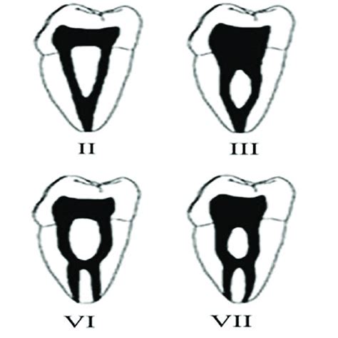 Vertucci Classification Of Root Canal Configuration Download Scientific Diagram