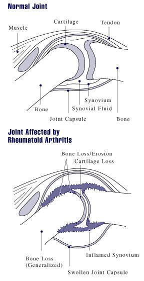 Difference Between Osteoarthritis And Rheumatoid Arthritis Definition Cause Risk Factors