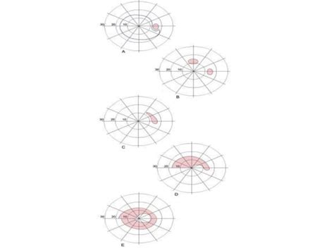 Visual Field Defects Pptx