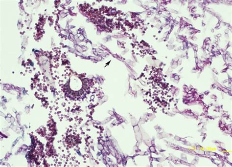 Histologic Section Of A Nasal Cavity Biopsy Showing An Aspergillus Spp Download Scientific
