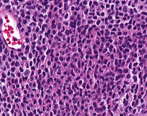 Pathology Outlines Cd99