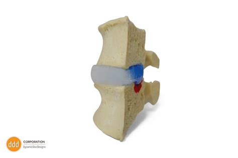 Schmorls Node Dynamic Disc Model