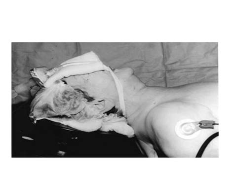 Thyroid Diseases And Anesthesia Management Pptx