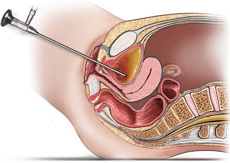 Rigid Cystoscopy Surgery Self Pay Surgery