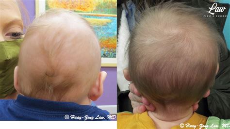 Craniosynostosis Before And After Photos Sage Plastic Surgery
