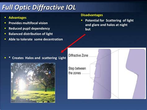 Ppt Eyediff Plus 3 50d Diffractive Multifocal Iol “a New Alternative