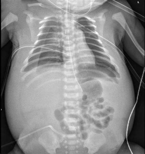 Necrotising Enterocolitis In A Newborn Infant Treated With Octreotide For Chylous Effusion Is