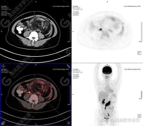 以平滑肌脂肪瘤为主的结节性硬化症一例 知乎