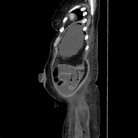 Fileesophageal And Gastric Pneumatosis Portal Venous Gas Radiopaedia