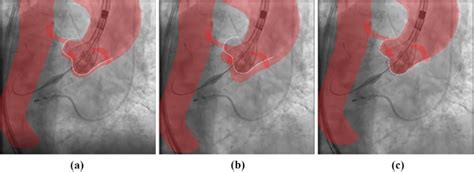 Motion Compensated Image Fusion A Reference Model Overlay Without Download Scientific
