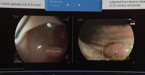 South Shore University Hospital Using Ai To Detect Polyps That Can Lead