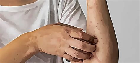 Sintomi Psoriasi Guttata