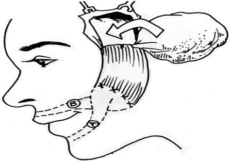 A Modified Technique Of Transposition Of Temporalis Muscle I Journal Of Craniofacial Surgery A Modified Technique Of Transposition Of Temporalis Muscle I Journal Of Craniofacial Surgery