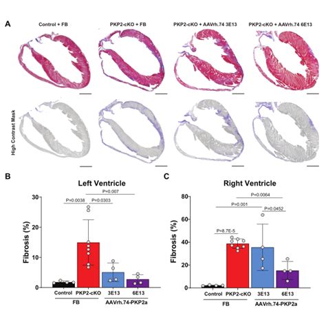 Amounts Of Diffuse Fibrosis And Dense Scar In Different Regions Of The