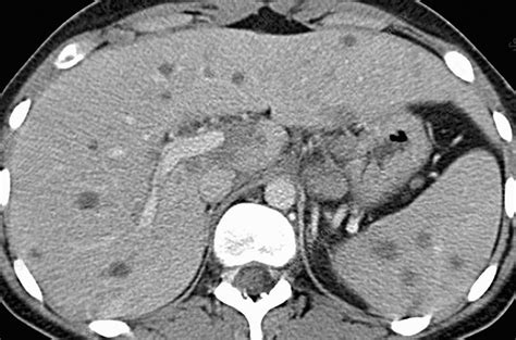 Hodgkins Lymphoma Ct Scan Stock Image C0226840 Science Photo
