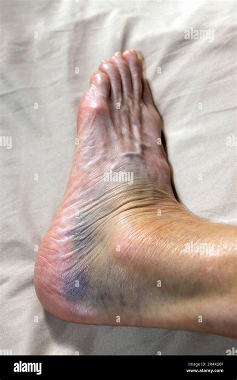Sprained Ankle