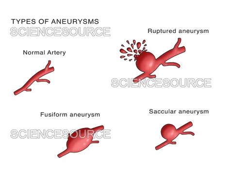 Types Of Saccular Aneurysm
