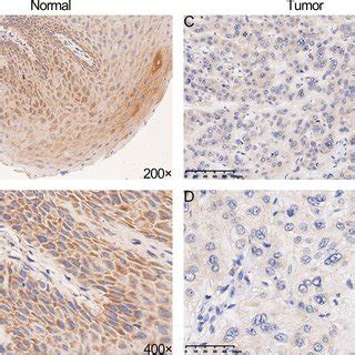 The Protein Expression Of YTHDC2 In Head And Neck Squamous Cell