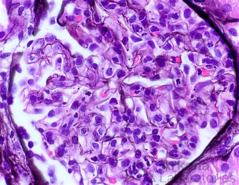 Class Iv Lupus Nephritis Diagnose This August 2 2022
