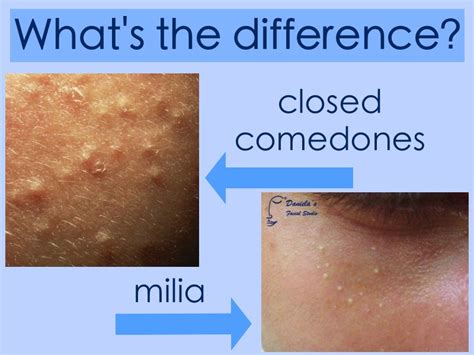 Comedones Whiteheads