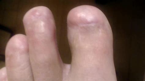 Toes Without Toenails Video ThisVid Com