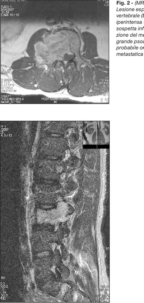 Figure 2 From Batsons Paravertebral Venous Plexus And Single Vertebral Metastases From Renal