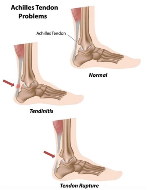 Managing Achilles Tendinopathy With Physical Therapy Mangiarelli