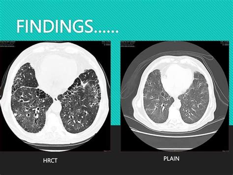 Hrct Chest Temporal Bone Protocol Pptx