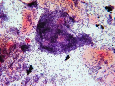 Fun With Microbiology Whats Buggin You Bacterial Vaginosis