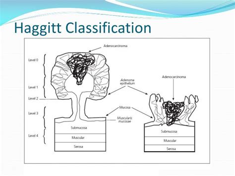 Ppt Treatment Of Early Malignant Rectal Polyp Powerpoint Presentation