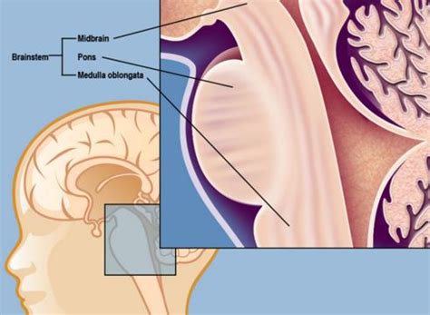 Diffuse Intrinsic Pontine Glioma Healthnwealth1