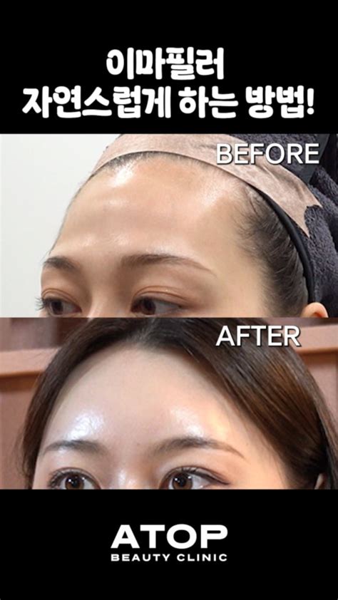 에이탑뷰티클리닉┃필러보톡스피부관리 처진 피부의 탄력을 더해주는 에이탑 볼뉴머 리프팅 피부가 처지면서 생기는 팔자