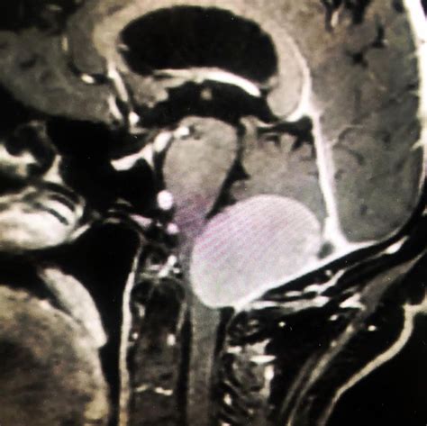 Ivan Perales On Linkedin Meningioma Microsurgical