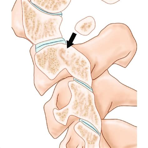 Sagittal Reformatted Computed Tomography Of The Axis Illustrating The Download Scientific