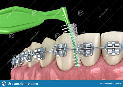 Interdental Tooth Brush And Braces Cleaning Medically Accurate 3d