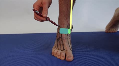 Navicular Stress Fracture Top Of Foot