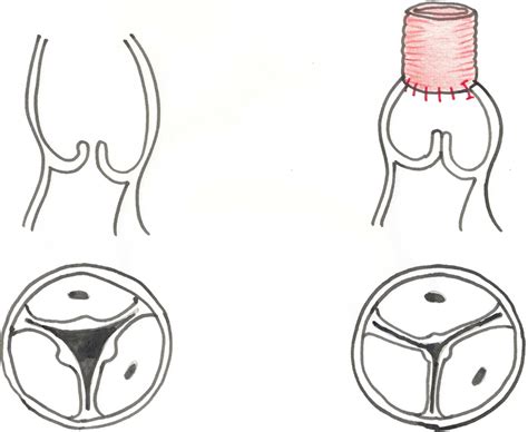 Ascending Aorta Replacement Download Scientific Diagram
