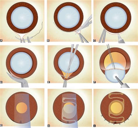 Extracapsular Cataract Extraction Illustration