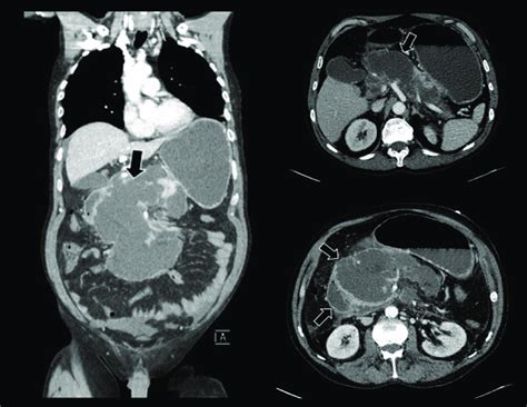Computed Tomography Ct Imaging Of The Abdomen With Intravenous