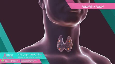 سرطان تیروئید