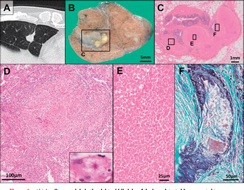 Figure 1 From A Solitary Necrotizing Sarcoid Granulomatosis Like