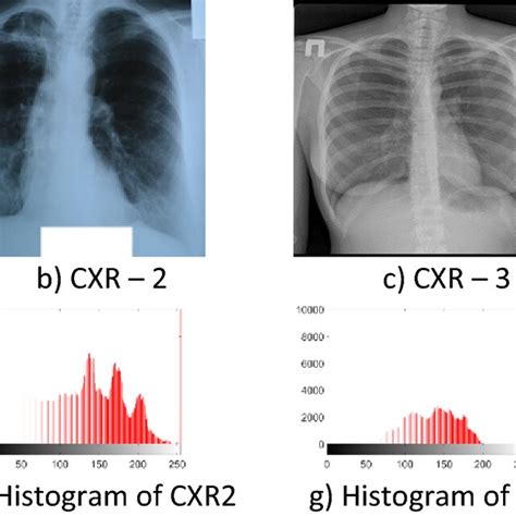 Intra Class Variation Of Tb Cxr Images Download Scientific Diagram