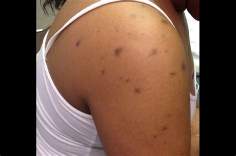 Derm Dx Hyperpigmented Nodules On The Arms And Back Clinical Advisor