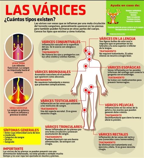 Cuantos Tipos De Varices Rema Productos Organicos Facebook