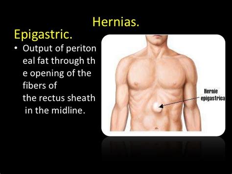 Hernias Ingl