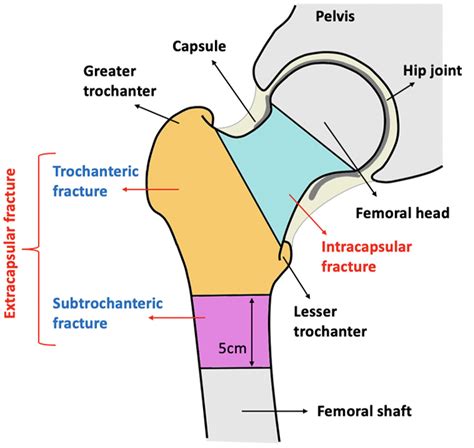 Intracapsular Vs Extracapsular Hip Fractures Geeky Medics